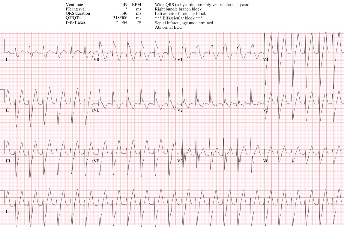 EM Cases | ECG Cases 19: tachycardias