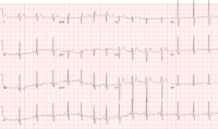 EM Cases | ECG Cases 19: tachycardias