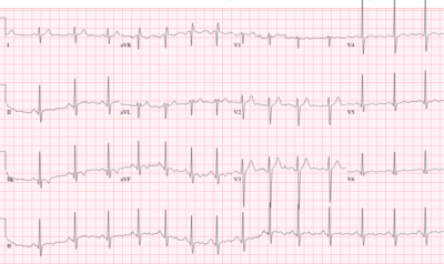 EM Cases | ECG Cases 19: tachycardias