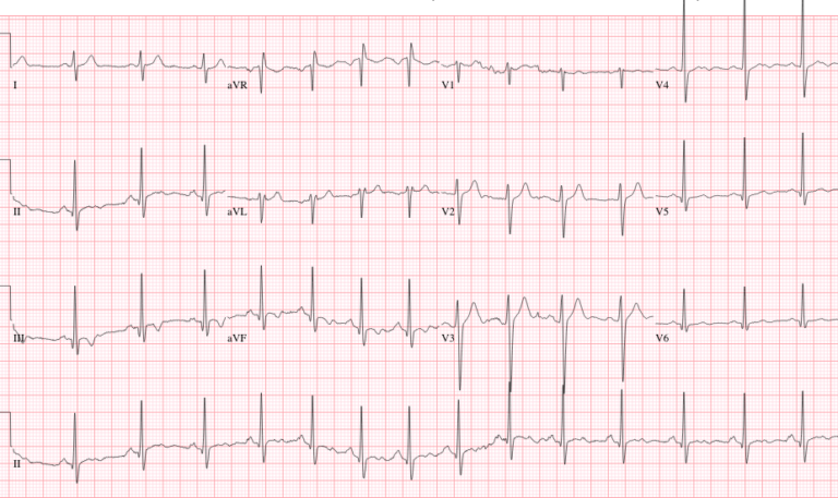 EM Cases | ECG Cases 19: tachycardias