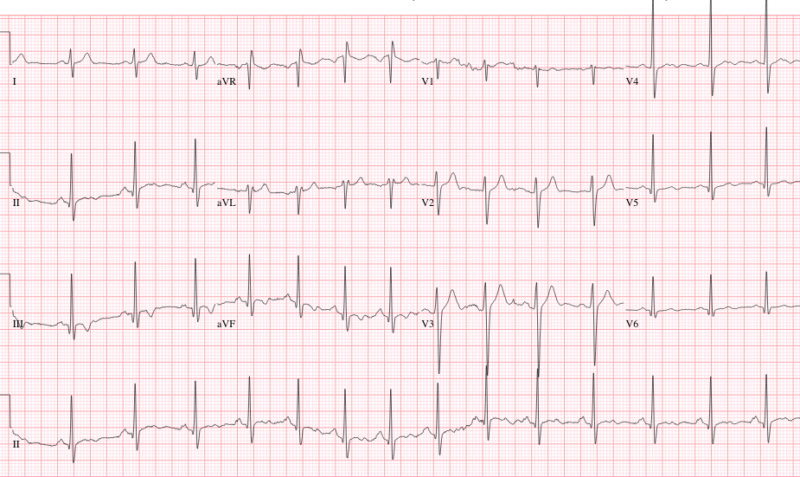 EM Cases | ECG Cases 19: tachycardias