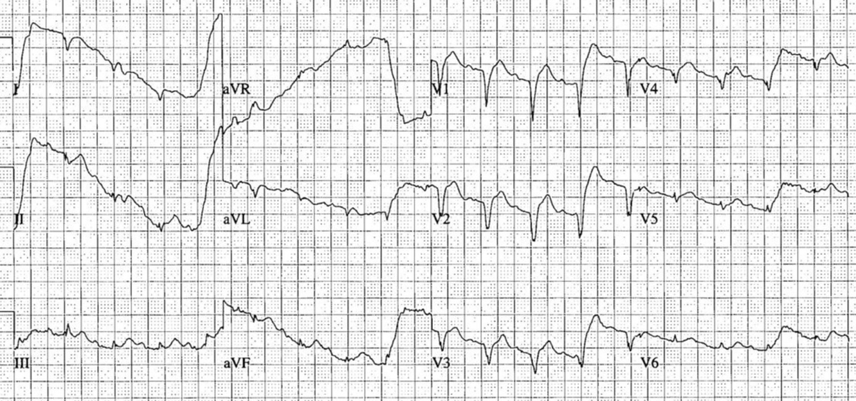 EM Cases | ECG Cases 19: tachycardias