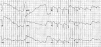 EM Cases | ECG Cases 19: tachycardias
