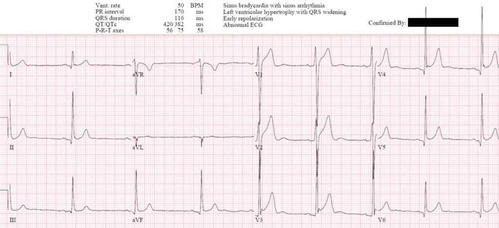 Hyperacute T waves and Occlusion MI | ECG Cases| Emergency Medicine Cases