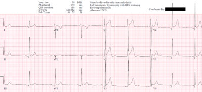 Hyperacute T waves and Occlusion MI | ECG Cases| Emergency Medicine Cases
