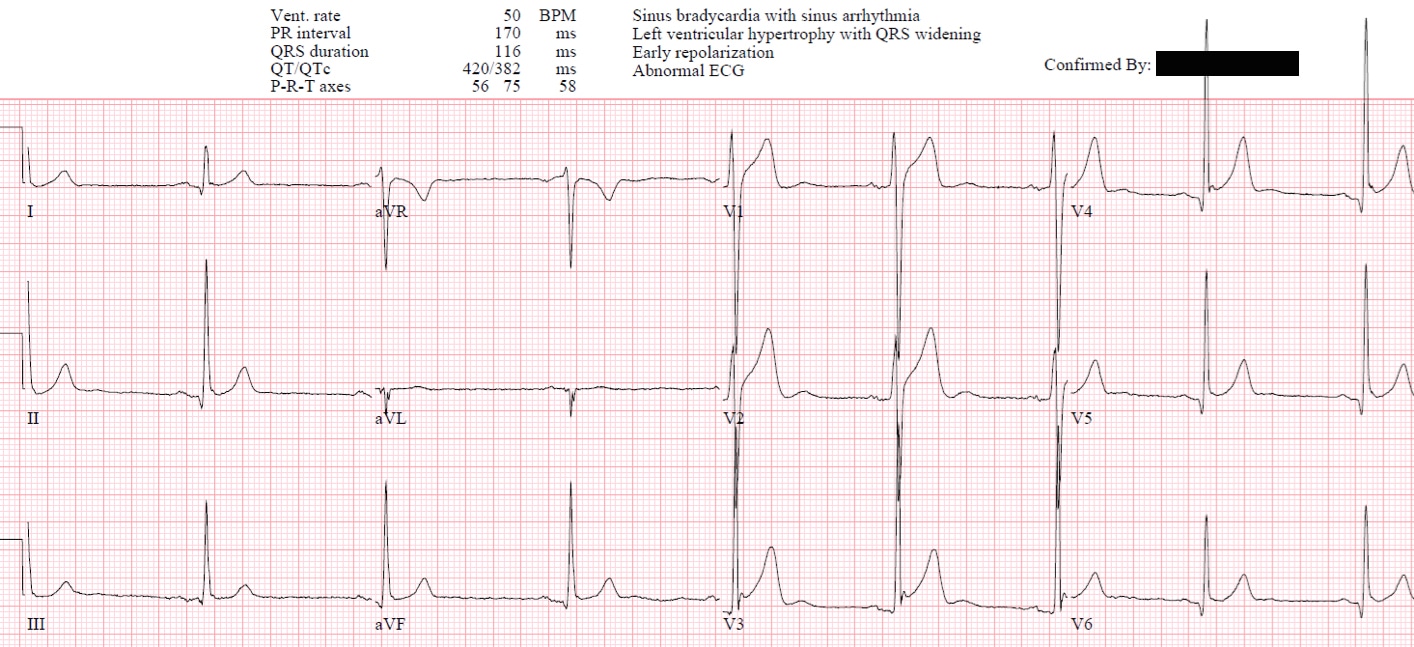 Hyperacute T waves and Occlusion MI | ECG Cases| Emergency Medicine Cases