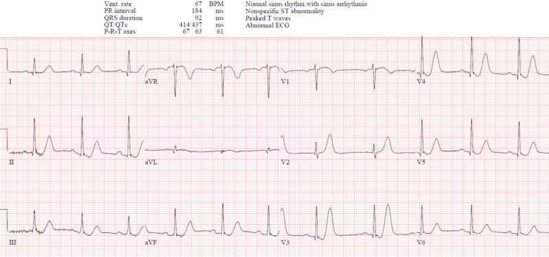 Hyperacute T waves and Occlusion MI | ECG Cases| Emergency Medicine Cases