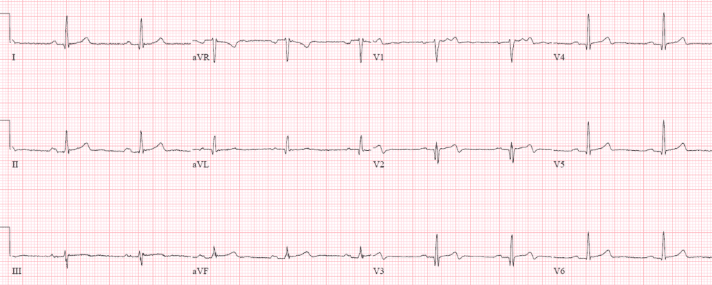 Hyperacute T waves and Occlusion MI | ECG Cases| Emergency Medicine Cases