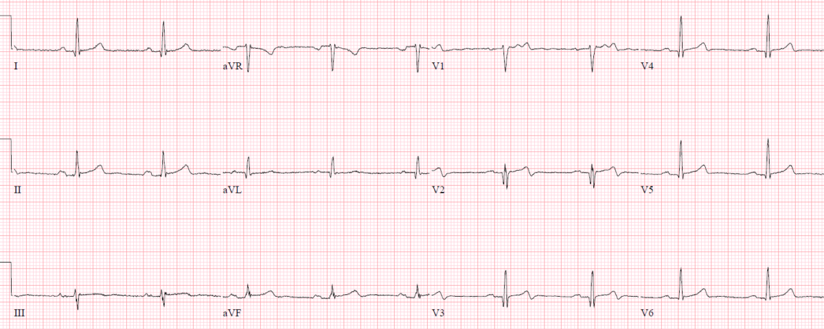Hyperacute T waves and Occlusion MI | ECG Cases| Emergency Medicine Cases
