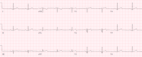 Hyperacute T waves and Occlusion MI | ECG Cases| Emergency Medicine Cases