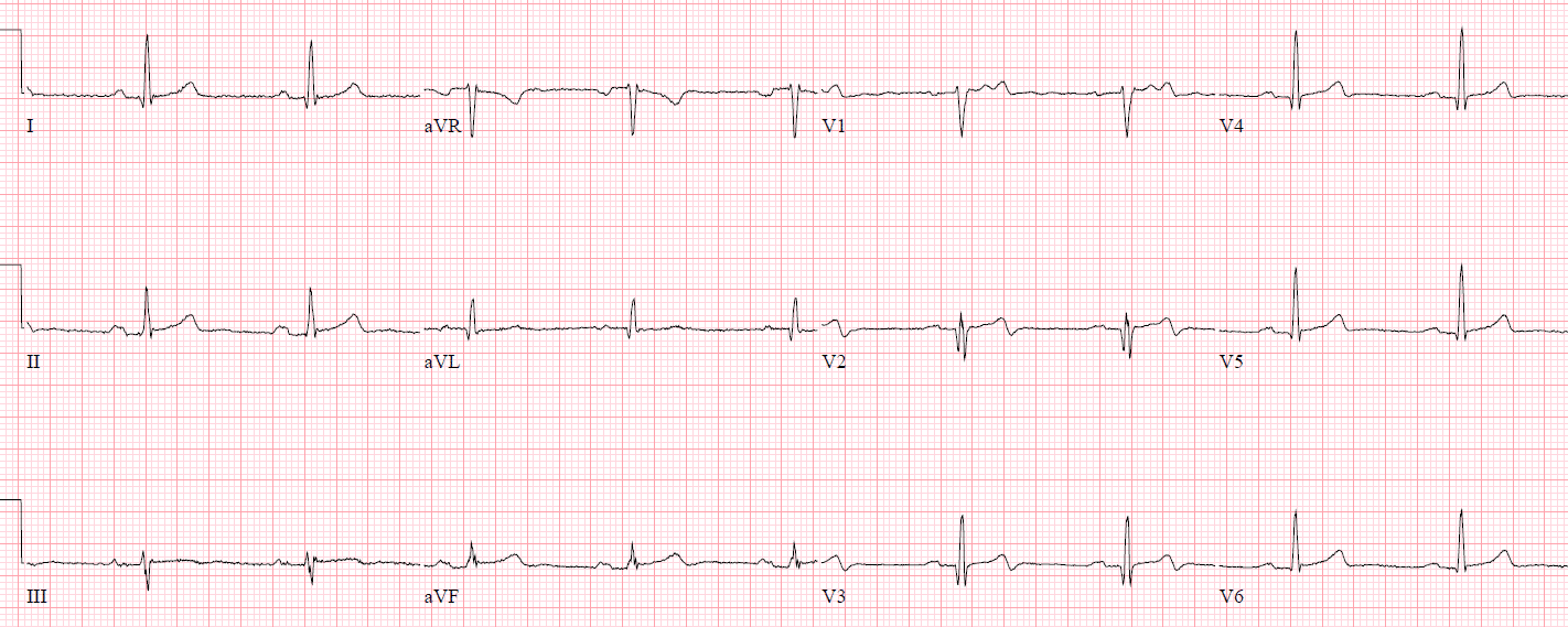 Hyperacute T waves and Occlusion MI | ECG Cases| Emergency Medicine Cases