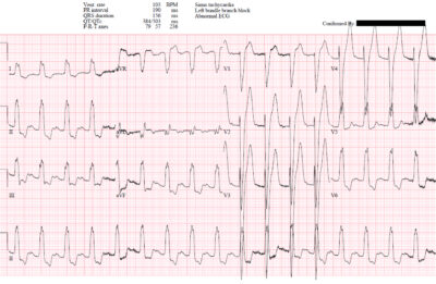 Hyperacute T waves and Occlusion MI | ECG Cases| Emergency Medicine Cases