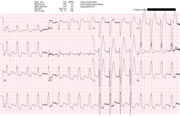 Hyperacute T waves and Occlusion MI | ECG Cases| Emergency Medicine Cases