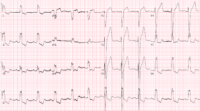 Hyperacute T waves and Occlusion MI | ECG Cases| Emergency Medicine Cases