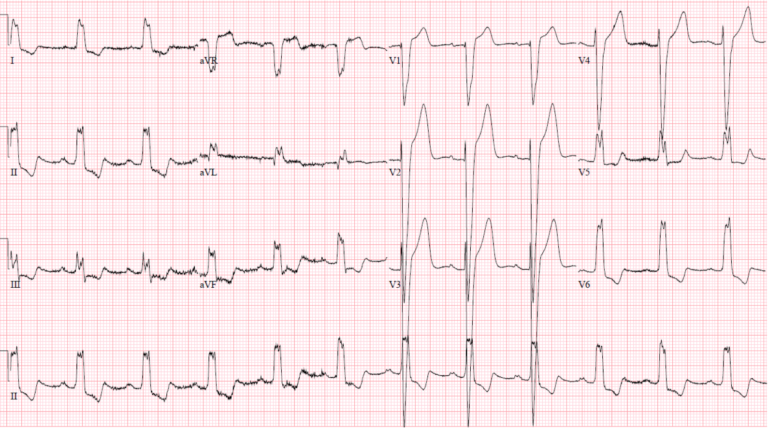 Hyperacute T waves and Occlusion MI | ECG Cases| Emergency Medicine Cases