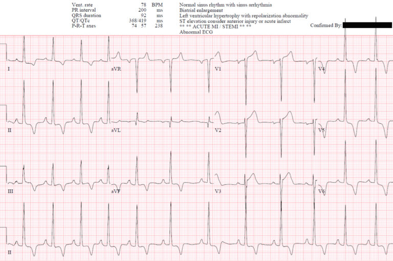 Hyperacute T waves and Occlusion MI | ECG Cases| Emergency Medicine Cases