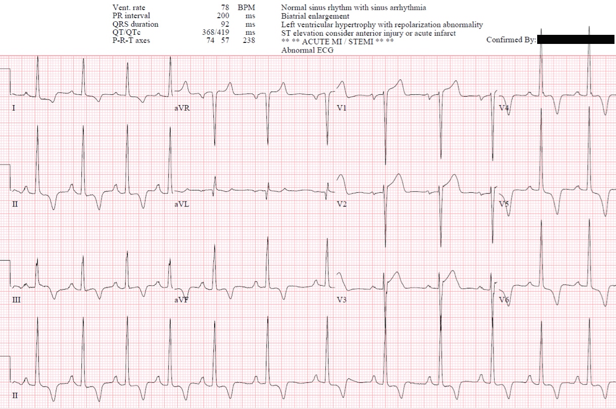 Hyperacute T waves and Occlusion MI | ECG Cases| Emergency Medicine Cases