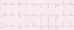 Hyperacute T waves and Occlusion MI | ECG Cases| Emergency Medicine Cases