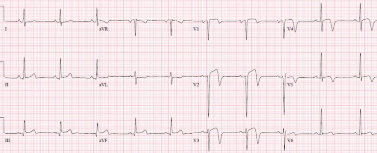 Hyperacute T waves and Occlusion MI | ECG Cases| Emergency Medicine Cases