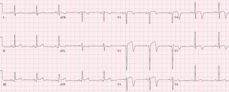 Hyperacute T waves and Occlusion MI | ECG Cases| Emergency Medicine Cases