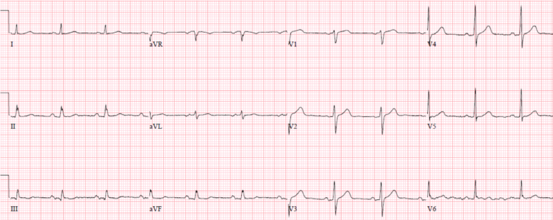 Hyperacute T waves and Occlusion MI | ECG Cases| Emergency Medicine Cases