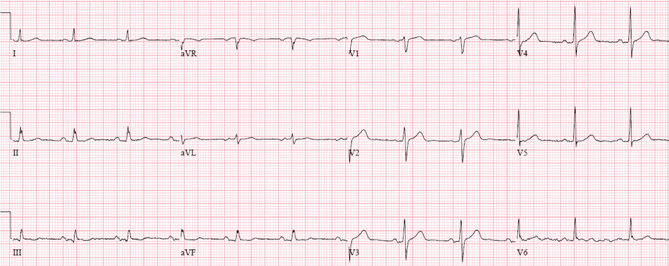 Hyperacute T waves and Occlusion MI | ECG Cases| Emergency Medicine Cases