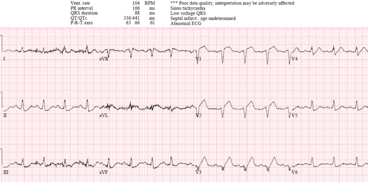 Hyperacute T waves and Occlusion MI | ECG Cases| Emergency Medicine Cases