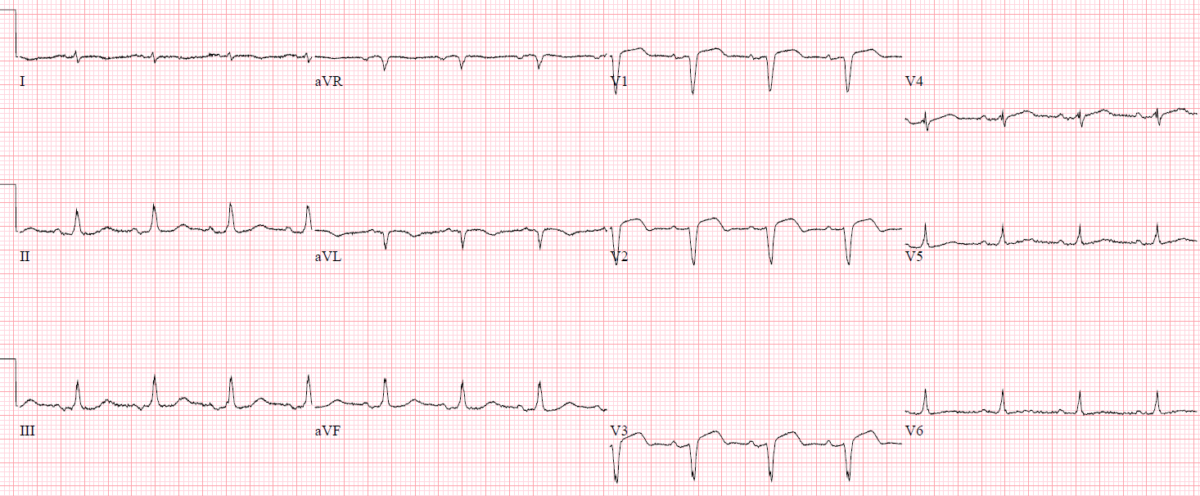 Hyperacute T waves and Occlusion MI | ECG Cases| Emergency Medicine Cases