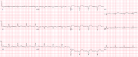 Hyperacute T waves and Occlusion MI | ECG Cases| Emergency Medicine Cases
