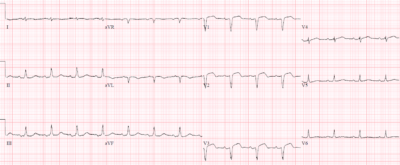 Hyperacute T waves and Occlusion MI | ECG Cases| Emergency Medicine Cases
