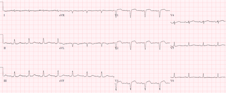 Hyperacute T waves and Occlusion MI | ECG Cases| Emergency Medicine Cases