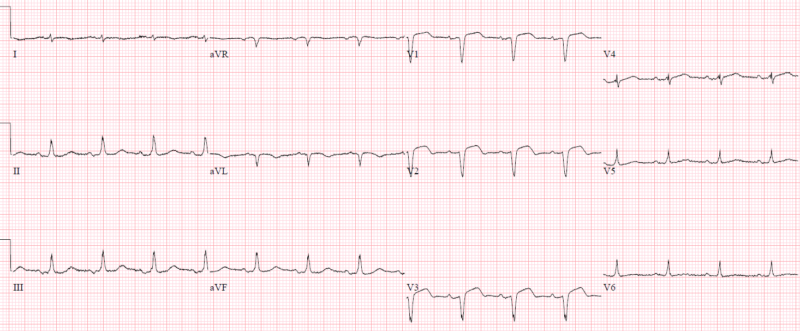 Hyperacute T waves and Occlusion MI | ECG Cases| Emergency Medicine Cases