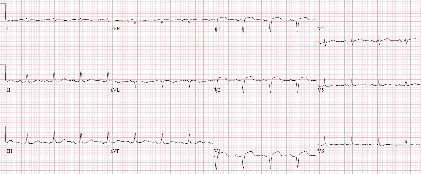 Hyperacute T waves and Occlusion MI | ECG Cases| Emergency Medicine Cases
