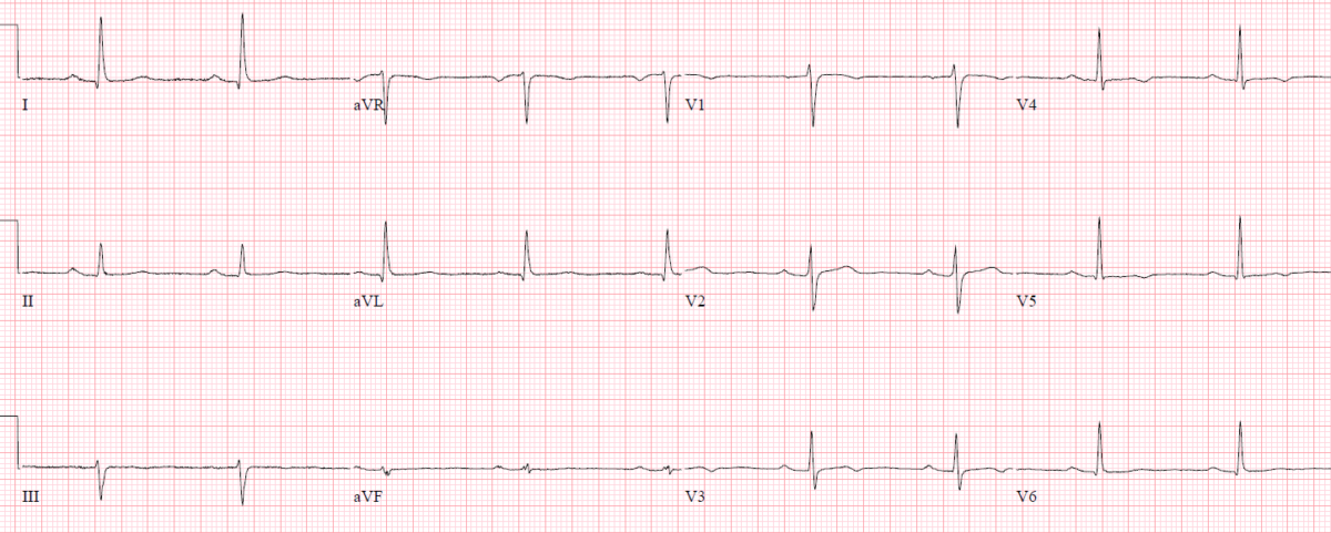 Hyperacute T waves and Occlusion MI | ECG Cases| Emergency Medicine Cases