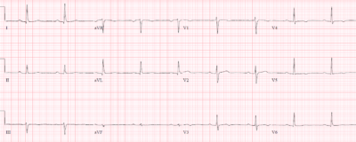 Hyperacute T waves and Occlusion MI | ECG Cases| Emergency Medicine Cases