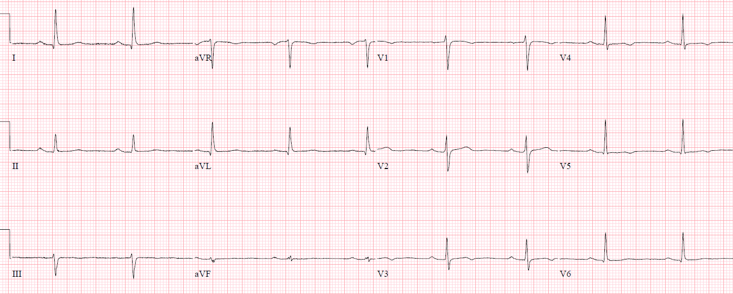 Hyperacute T waves and Occlusion MI | ECG Cases| Emergency Medicine Cases