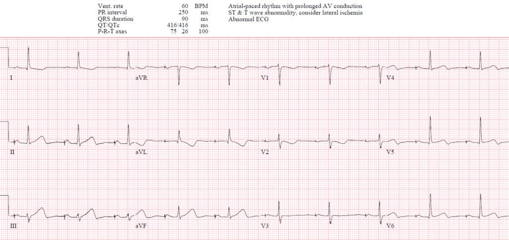 Hyperacute T waves and Occlusion MI | ECG Cases| Emergency Medicine Cases