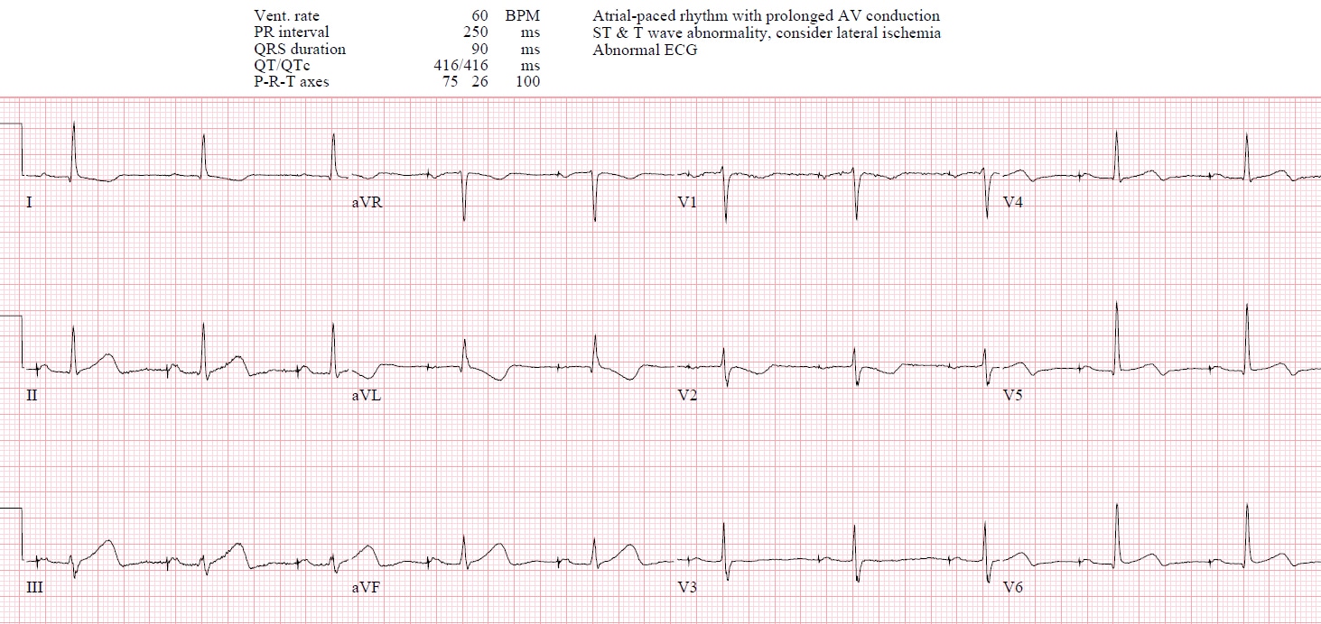 Hyperacute T waves and Occlusion MI | ECG Cases| Emergency Medicine Cases