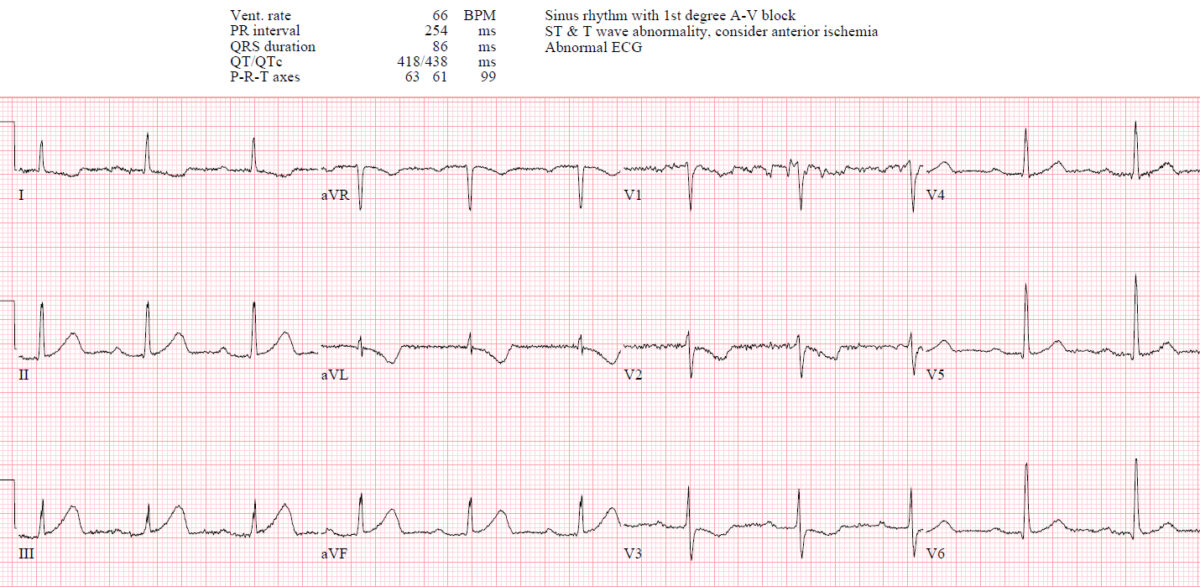 Hyperacute T waves and Occlusion MI | ECG Cases| Emergency Medicine Cases