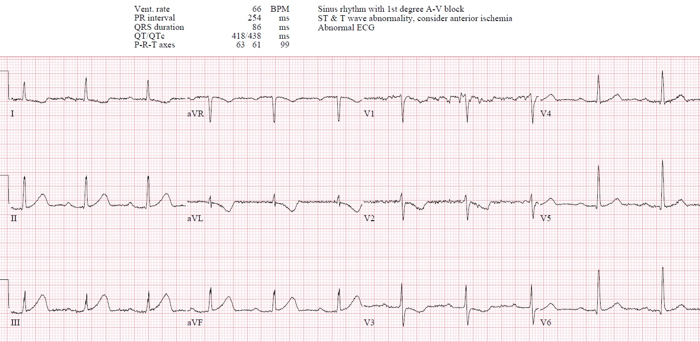 Hyperacute T waves and Occlusion MI | ECG Cases| Emergency Medicine Cases