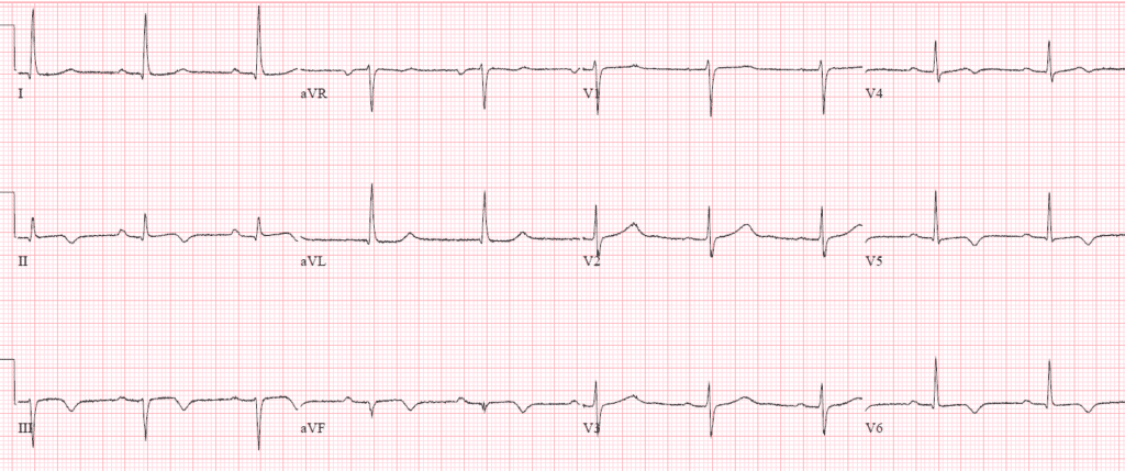 Hyperacute T waves and Occlusion MI | ECG Cases| Emergency Medicine Cases