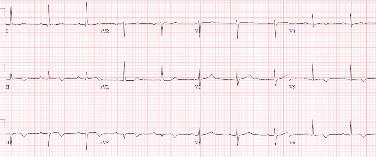 Hyperacute T waves and Occlusion MI | ECG Cases| Emergency Medicine Cases