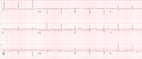 Hyperacute T waves and Occlusion MI | ECG Cases| Emergency Medicine Cases