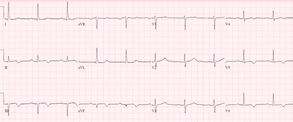 Hyperacute T waves and Occlusion MI | ECG Cases| Emergency Medicine Cases