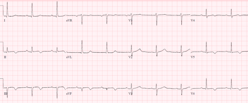 Hyperacute T waves and Occlusion MI | ECG Cases| Emergency Medicine Cases