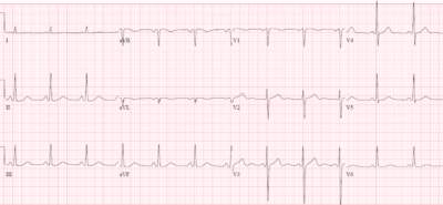Hyperacute T waves and Occlusion MI | ECG Cases| Emergency Medicine Cases