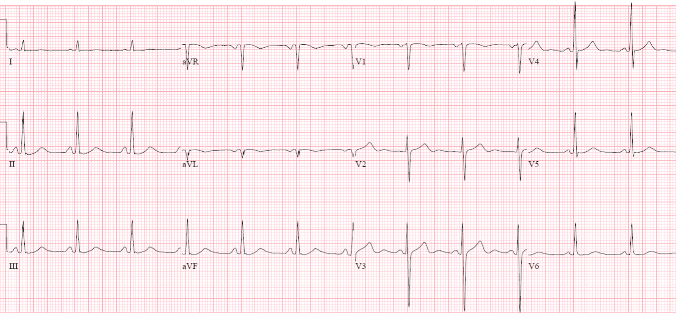 Hyperacute T waves and Occlusion MI | ECG Cases| Emergency Medicine Cases