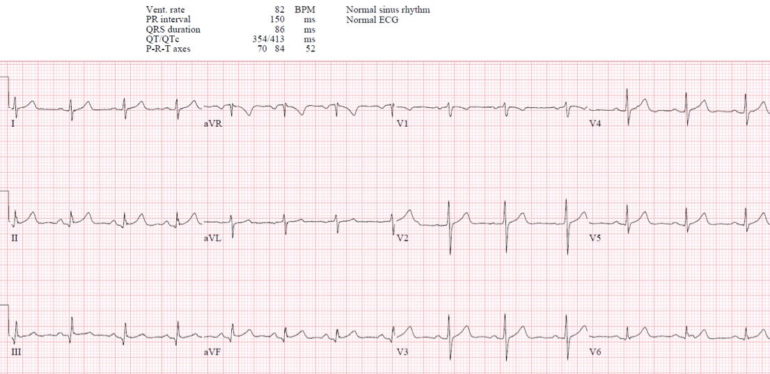 Hyperacute T waves and Occlusion MI | ECG Cases| Emergency Medicine Cases