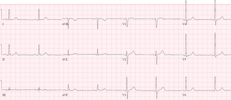 Hyperacute T waves and Occlusion MI | ECG Cases| Emergency Medicine Cases