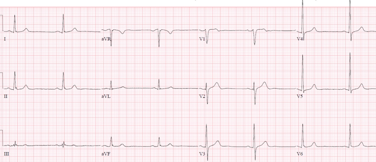 Hyperacute T waves and Occlusion MI | ECG Cases| Emergency Medicine Cases